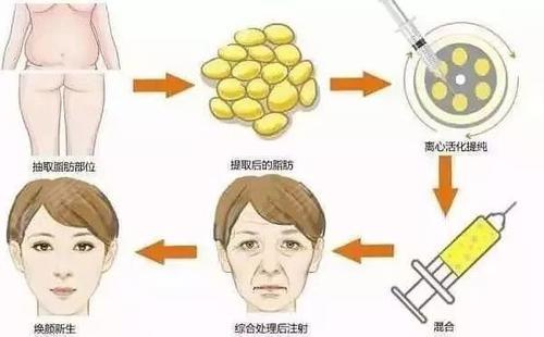 Do you really know these problems after a facial fat filler? - iNEWS