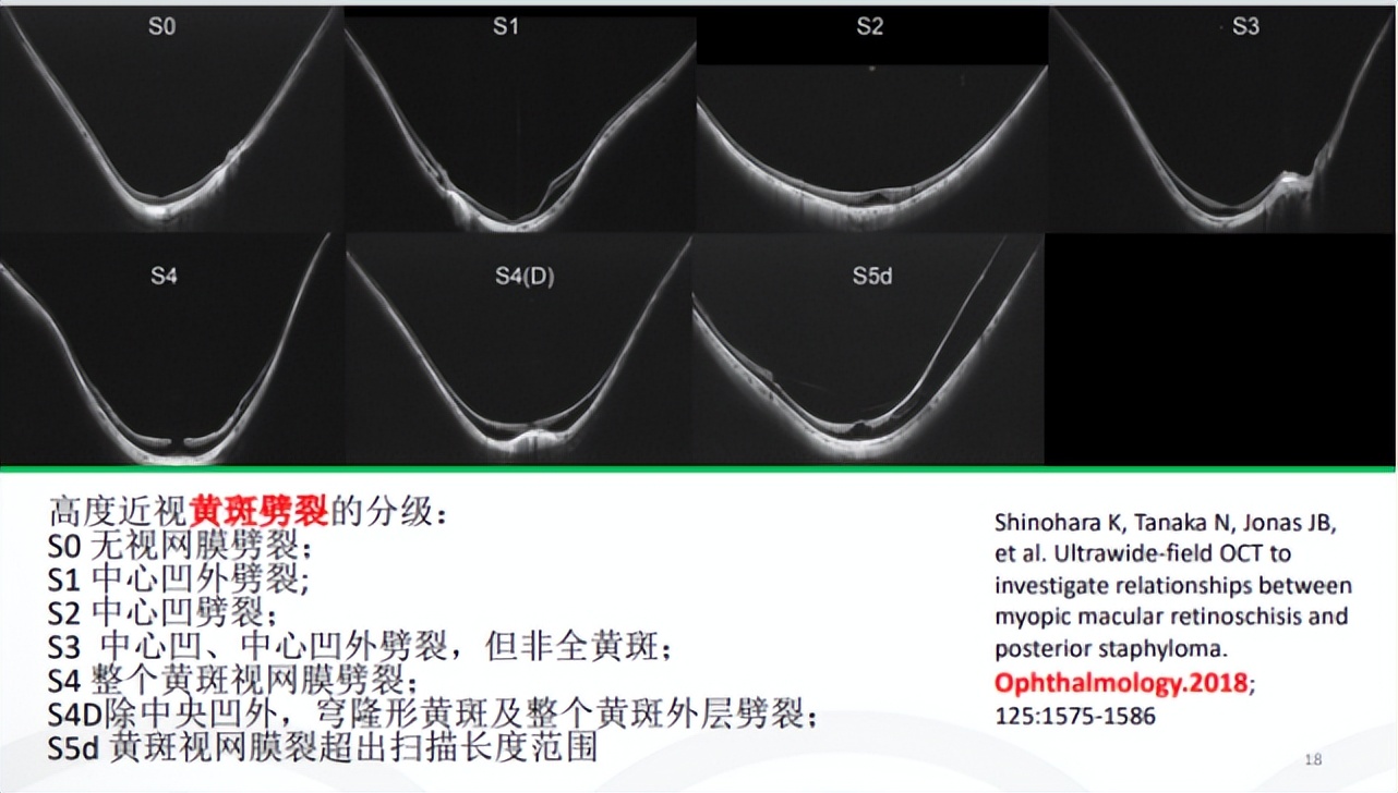 Professor Song Zongming talks about the grading and treatment of myopic ...