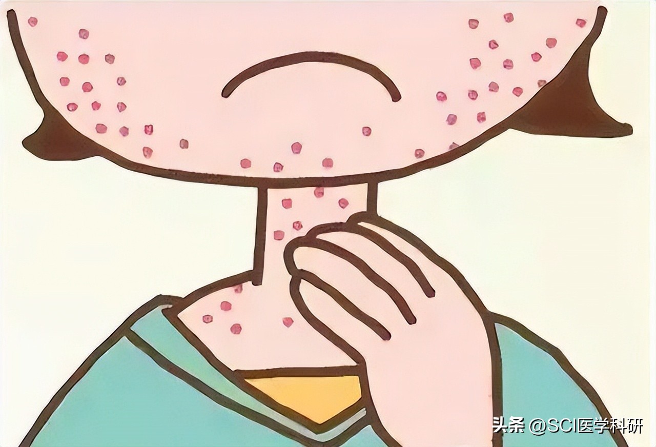Prurigo nodularis, itchy enough to "doubt life", ushered in a new ...