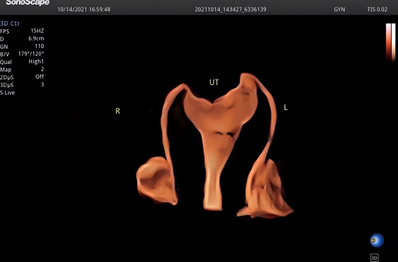 Hysterosalpingography contrast-enhanced ultrasound, Nanchang Third ...