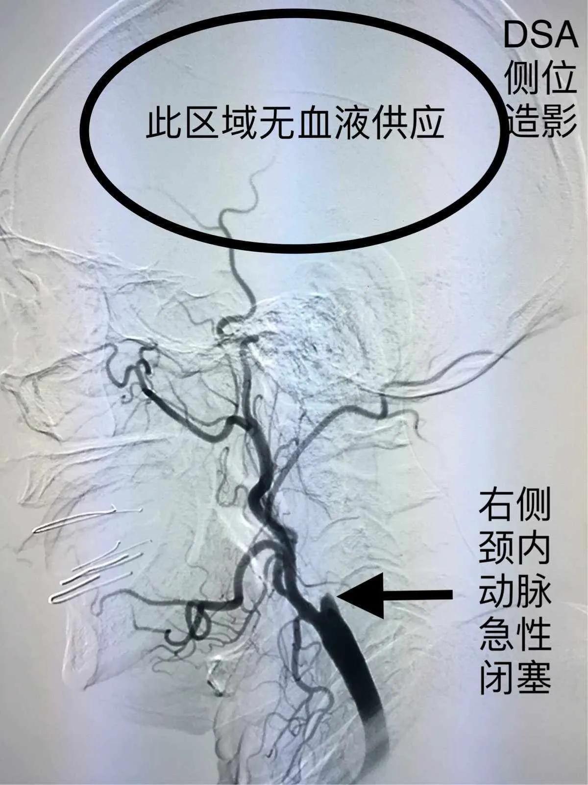 Stroke and cerebral infarction should be treated with DSA intervention ...
