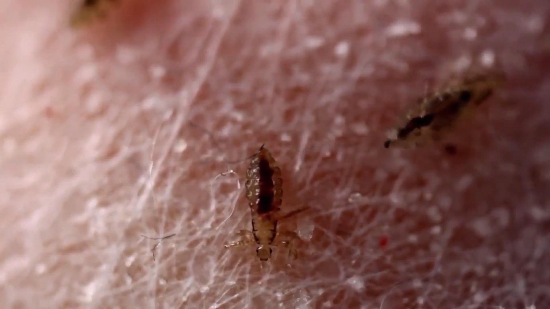 Lice that used to be common but are now hard to see? What are the ...