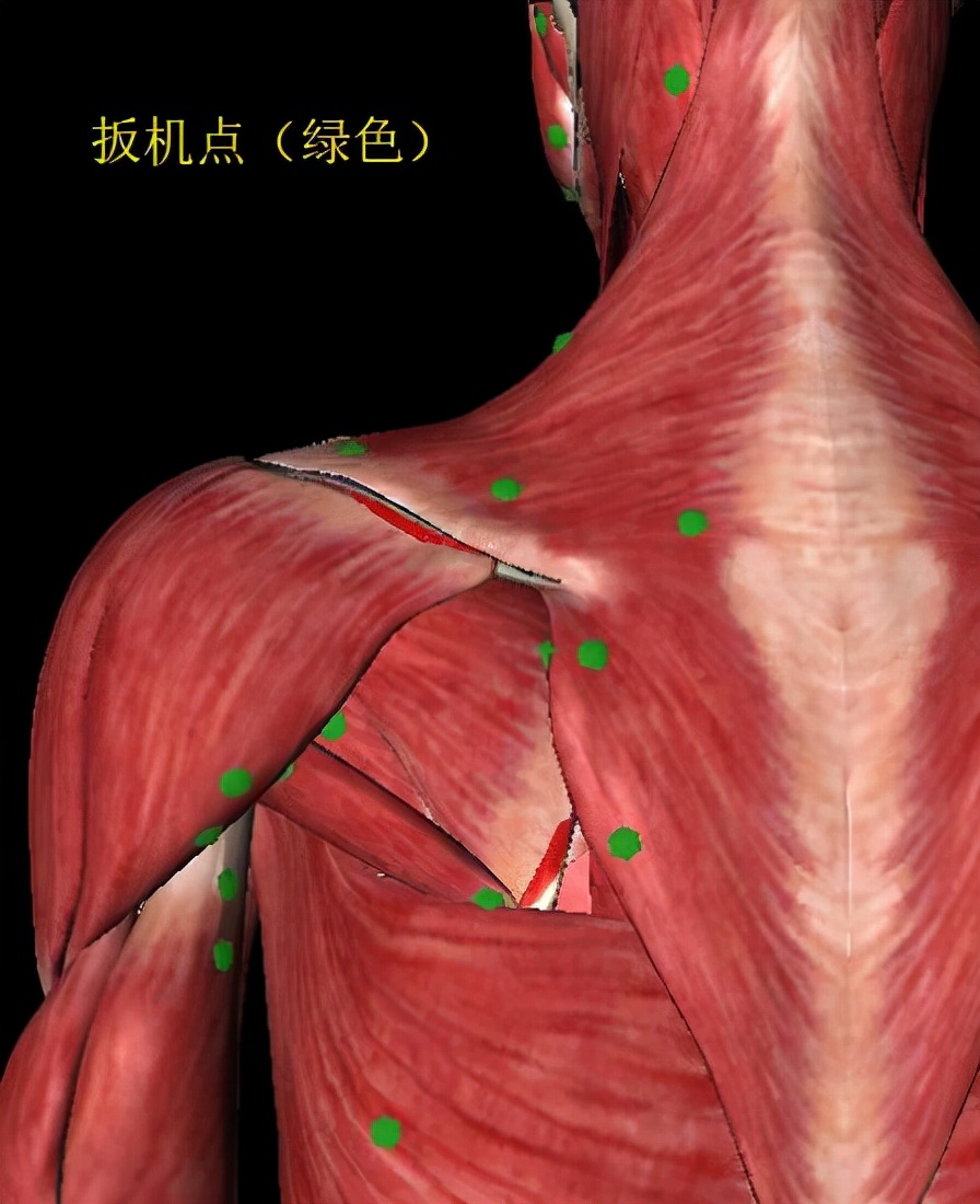 What is a trigger point?How is it different from tender points, trigger ...
