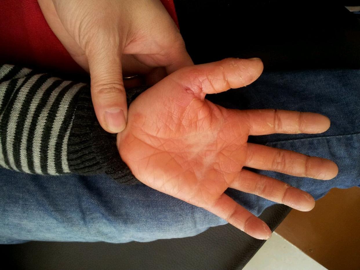 What causes peeling skin and ringworm on hands and feet?How to treat ...