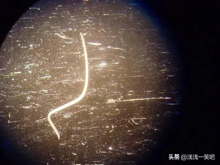 8-month-old baby boy has 8 parasites removed from his eyes, which are ...