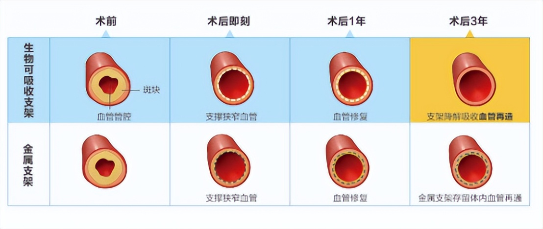 The world's first iron-based absorbable stent approved - iMedia