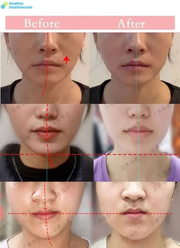 What kind of facial problems can be corrected by exercise? - iNEWS