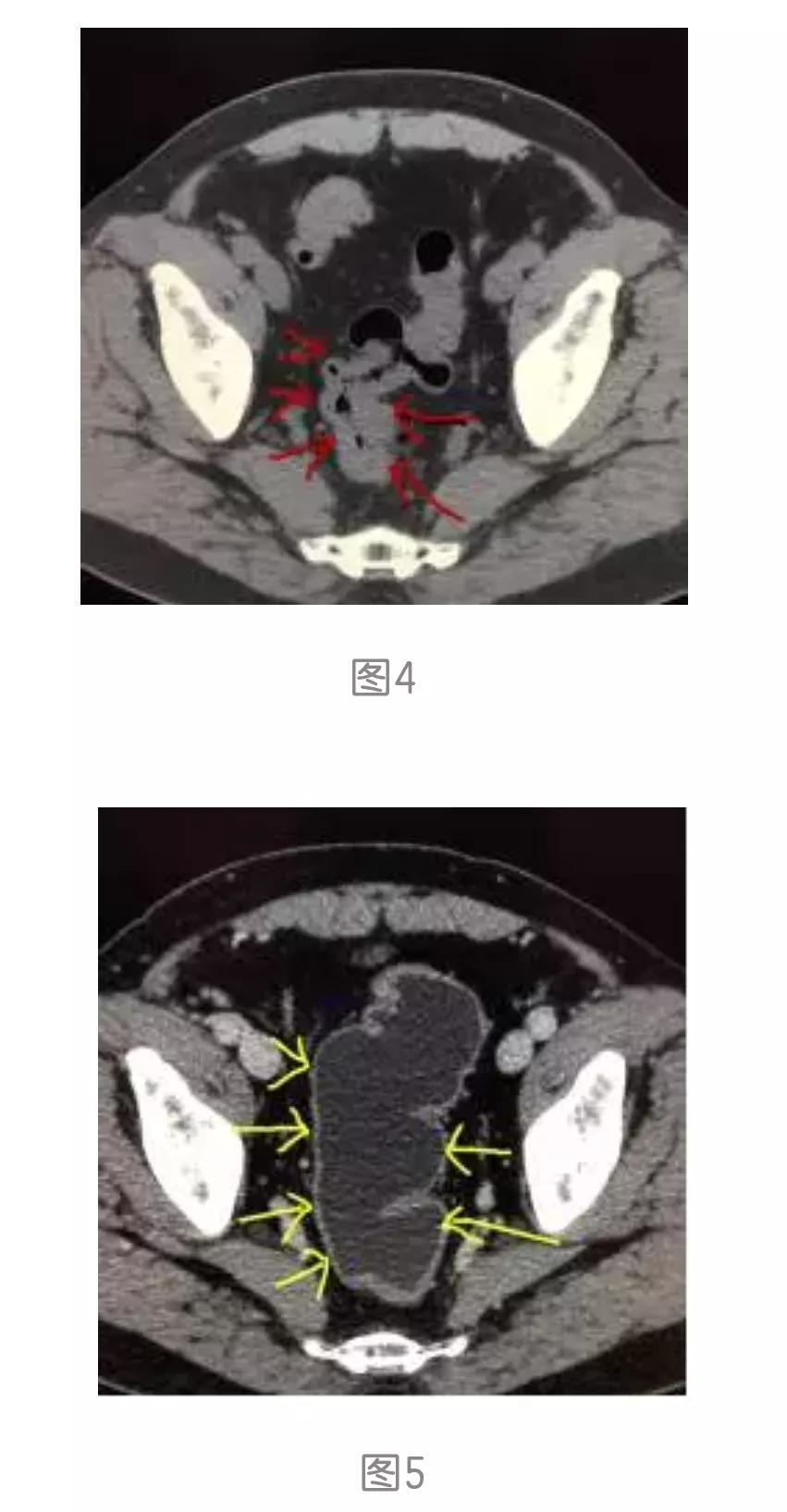 Why should I drink more water before abdominal CT scan? - iNEWS