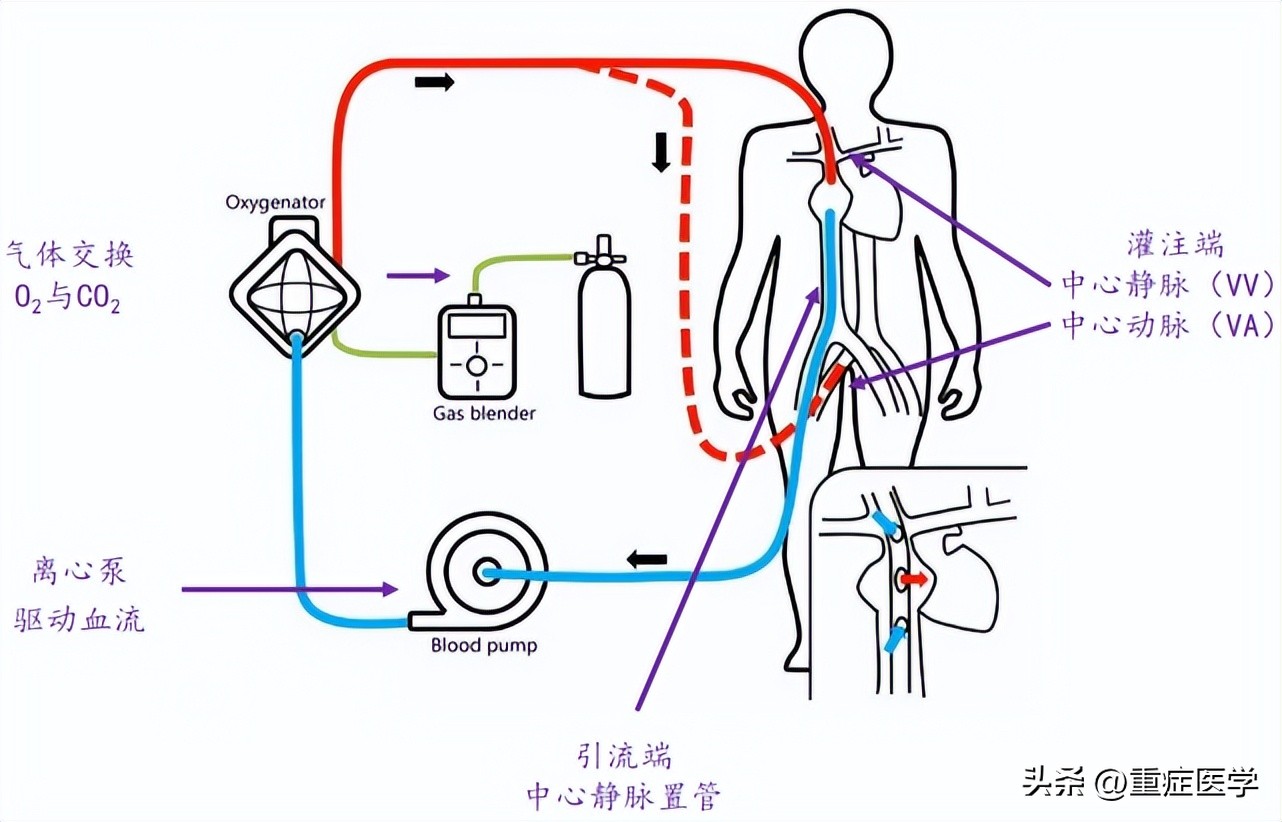 Prevention and treatment of ECMO complications - iNEWS