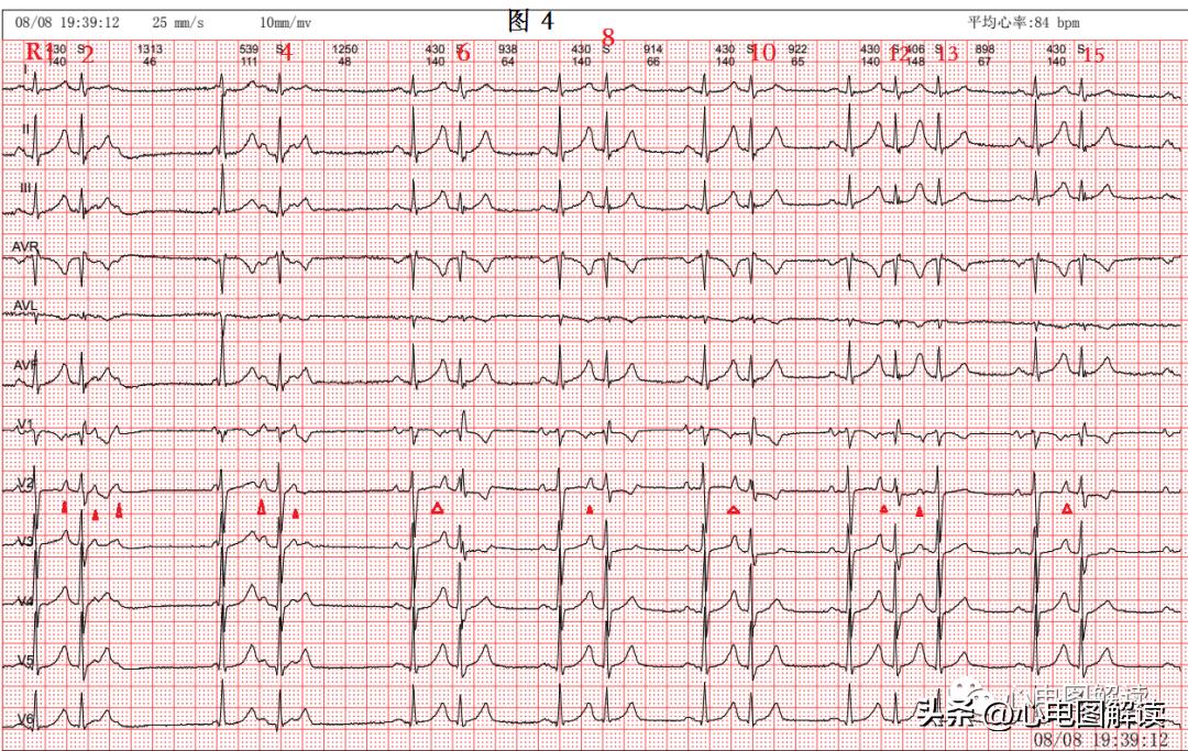 Premature atrial beats with episodic and non-downstream, atrial ...