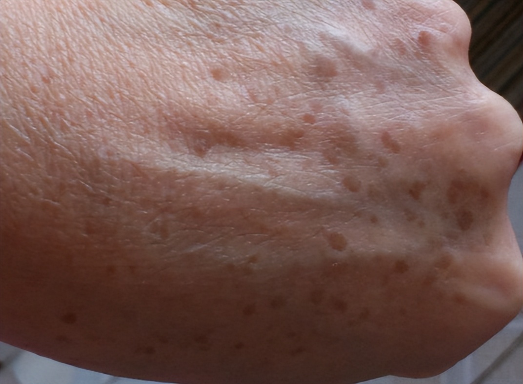 Don't mistake skin cancer for age spots - iNEWS