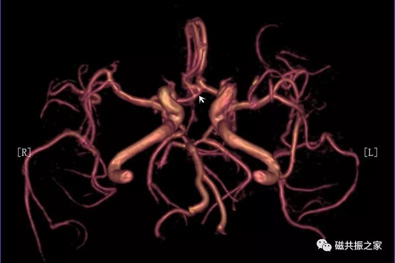 Common Normal Variations of Intracranial MRA - iNEWS