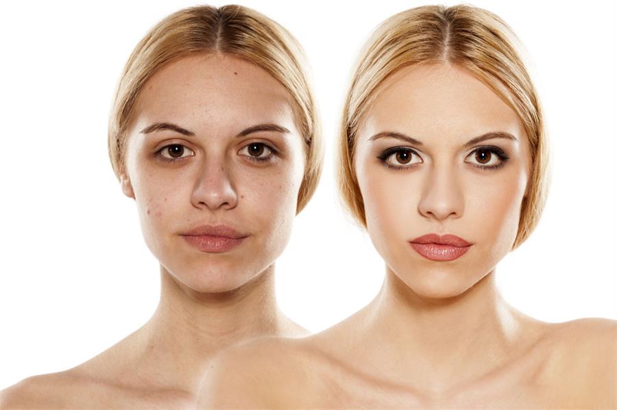 I love acne on my face, how can I succeed in "fighting acne"?4 tips ...