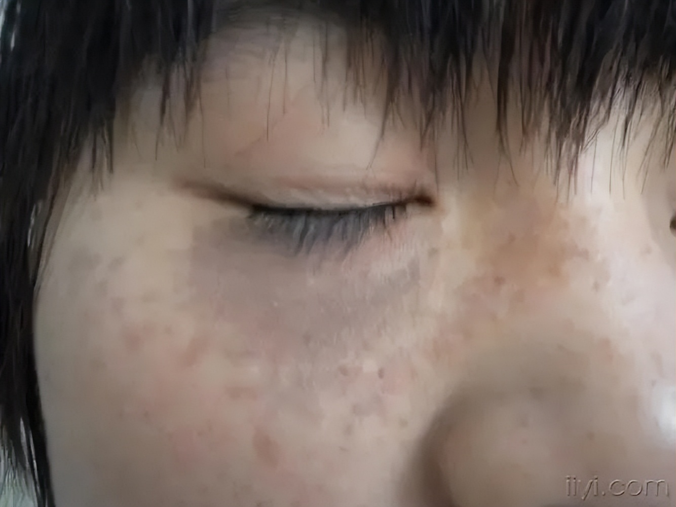 What causes nevus of Ota to form?Can it be removed? - iNEWS