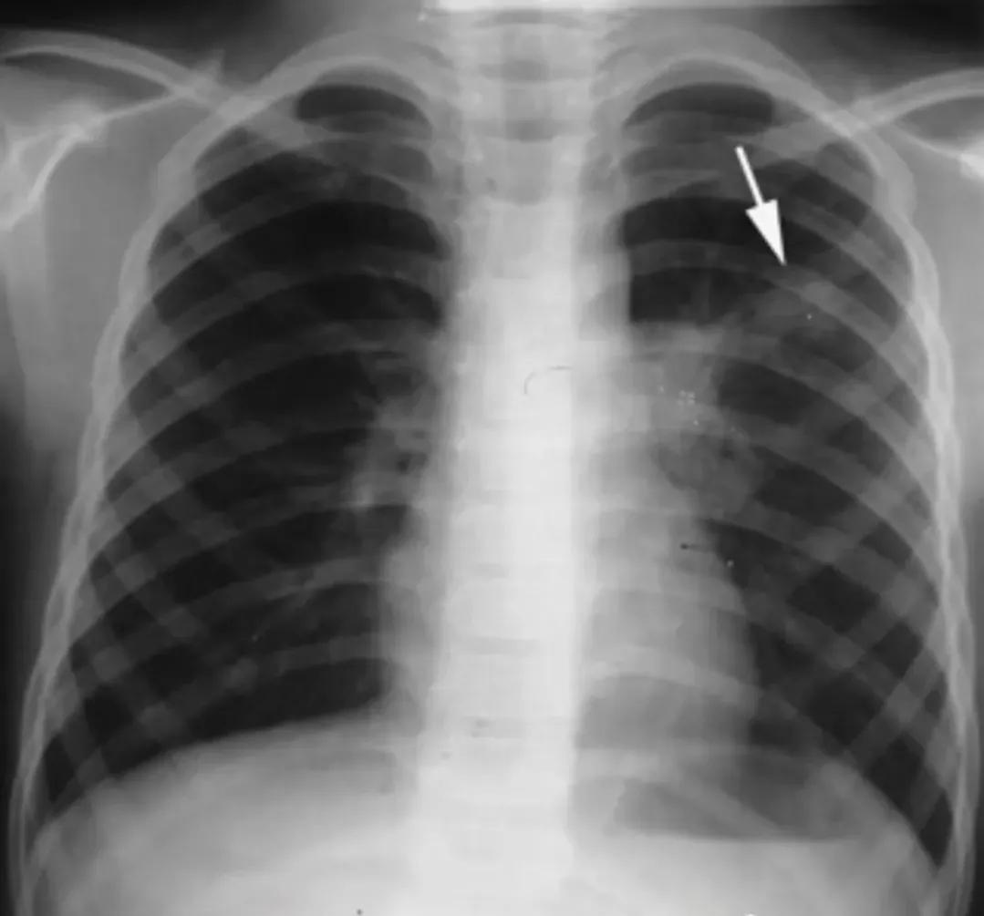 The classification and imaging manifestations of pulmonary tuberculosis ...