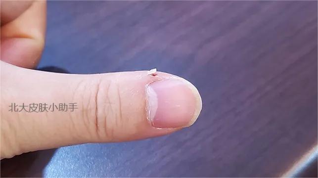 Handy, loves to pick, tear, and bite fingers! Can the dead skin around ...