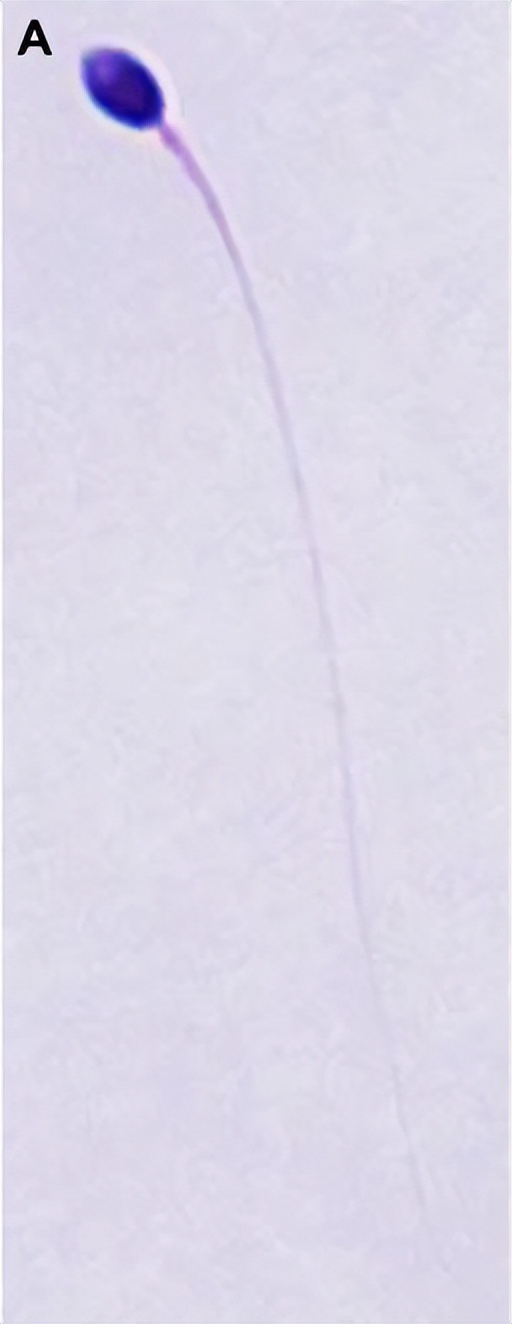 Sperm deformity rate is high, will there be deformed children? - iNEWS