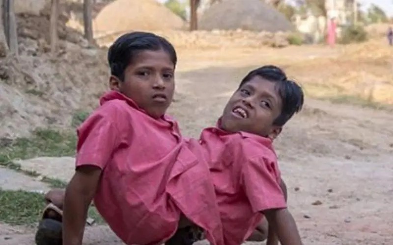 How are conjoined people formed?If one of them dies, will the other survive? - iNEWS