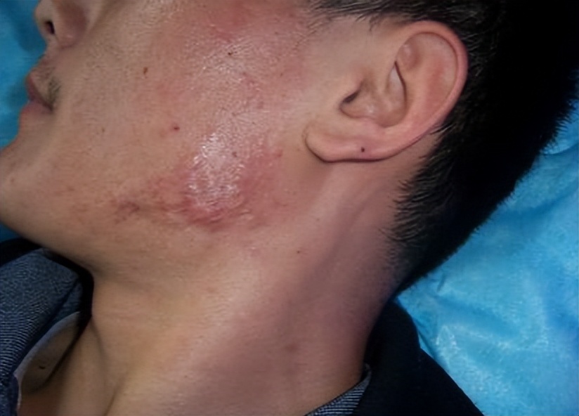 How to get rid of scars on the face? - iNEWS