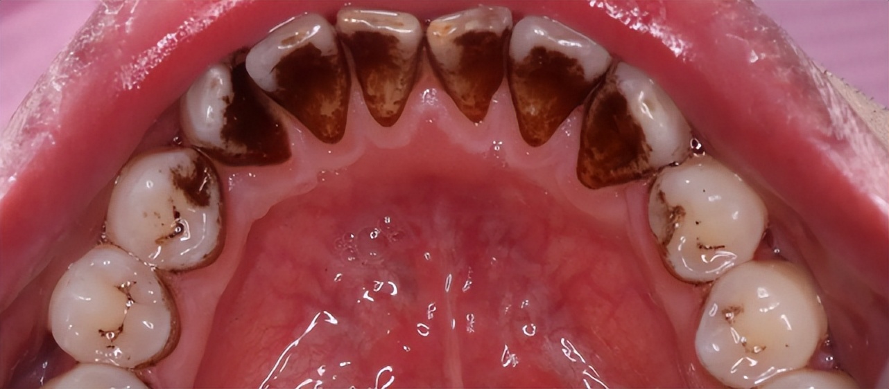 You can get rid of black teeth stains without quitting smoking!One more ...