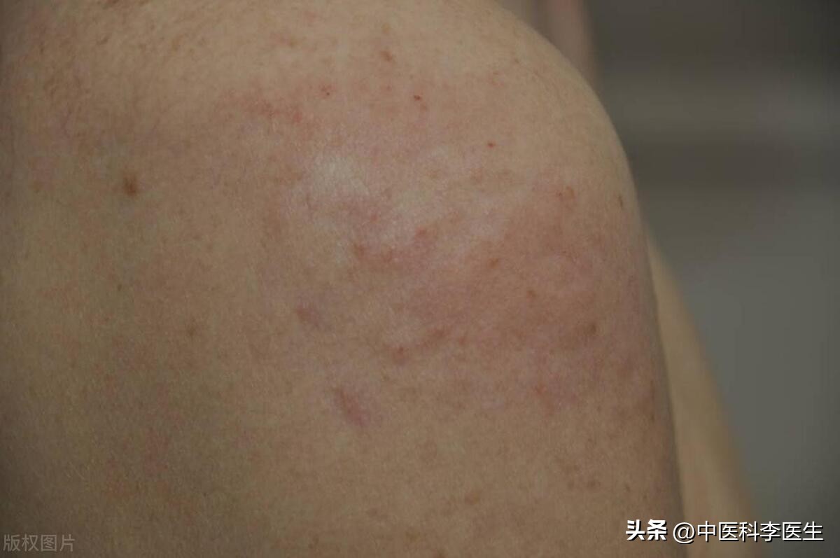 To deal with eczema, Chinese medicine has a "universal prescription ...