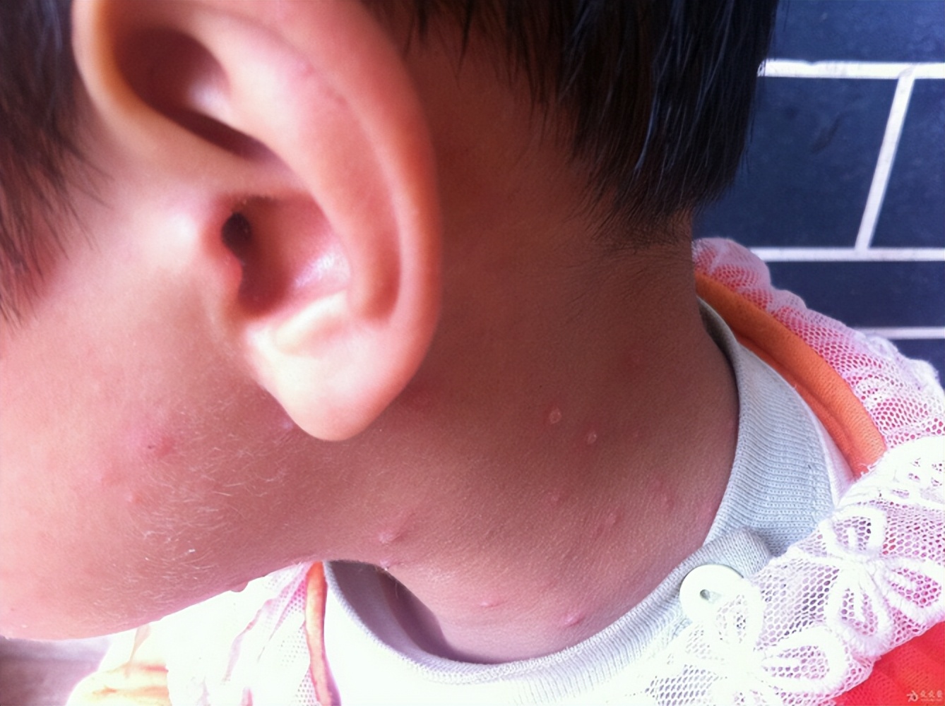 Prevention and treatment of skin diseases in children in spring - iNEWS