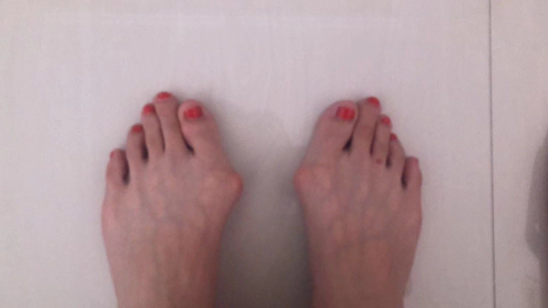 Hallux valgus combined with overlapping toes deformity, which has a lot ...