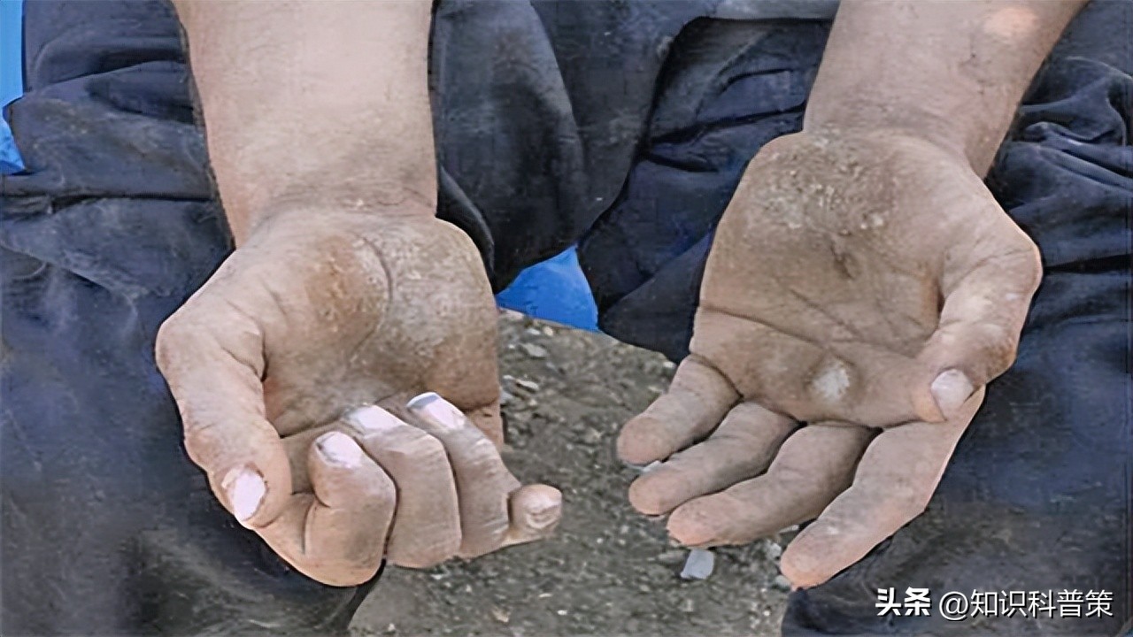 Reverse evolution syndrome: Scientists tell how family lives with only ...