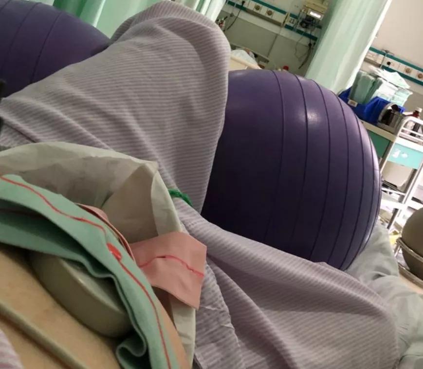 Recording the experience of transsection caused by placental abruption ...