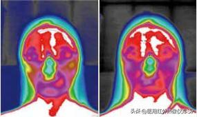 Comparison of the application and curative effect of medical infrared ...