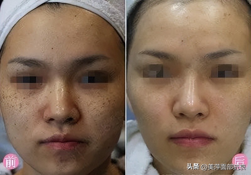 How do freckles form, and how can they be removed safely? - iMedia