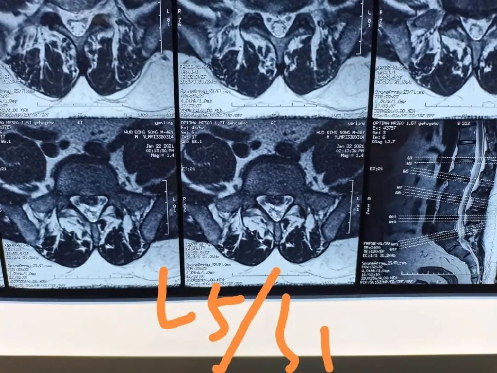 Treating "lumbar protrusion" is not as difficult as you think - iNEWS