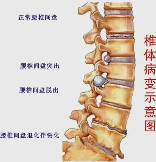 Femoral head necrosis and lumbar intervertebral disc herniation can't ...