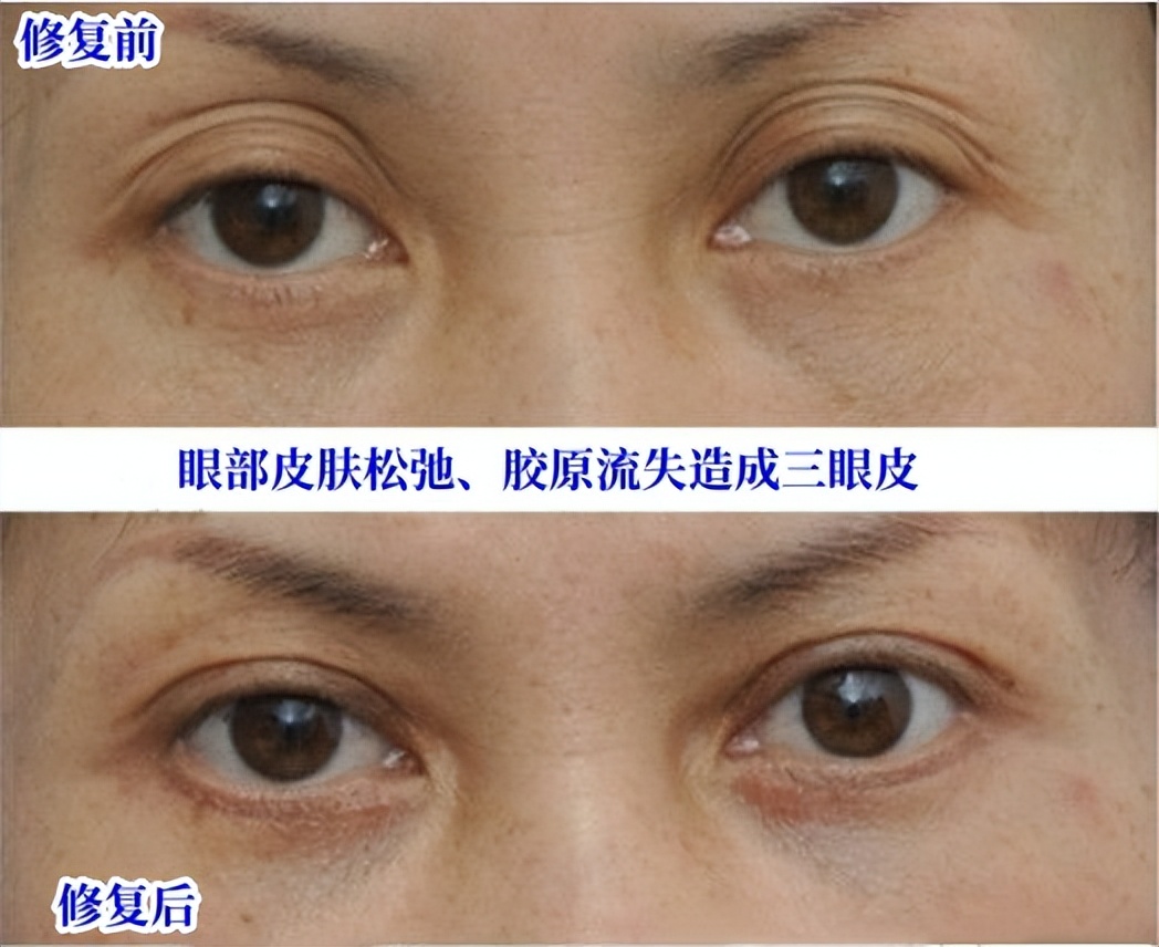 Why do double eyelids become triple eyelids? - iMedia