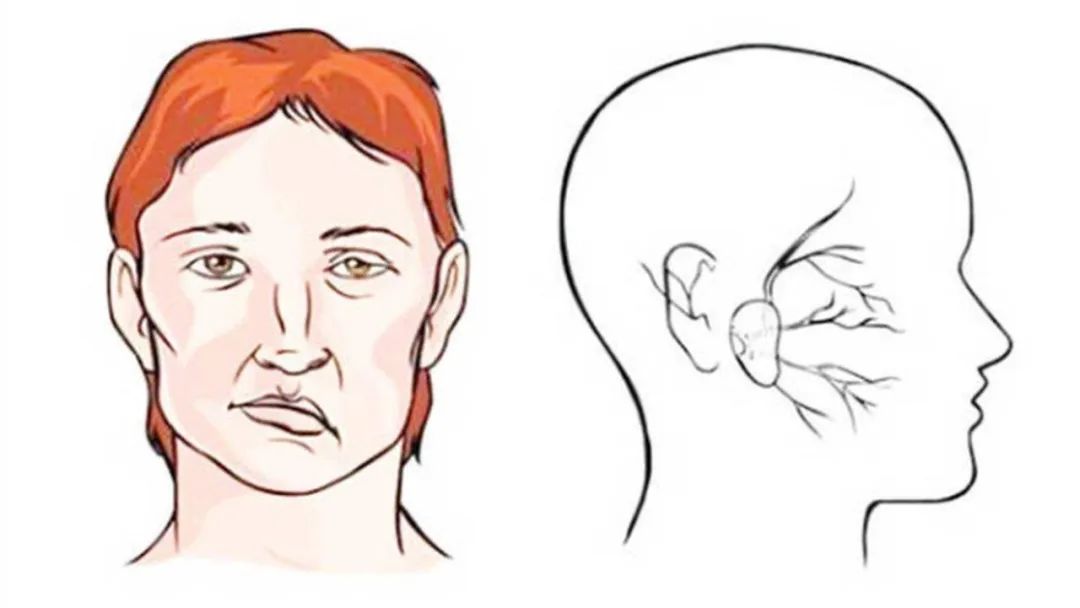 The old woman suffered from facial convulsions, and minimally invasive ...