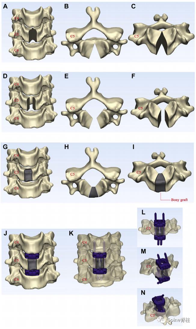 Professor Liu Hao's team from West China Hospital: Anterior cervical X ...