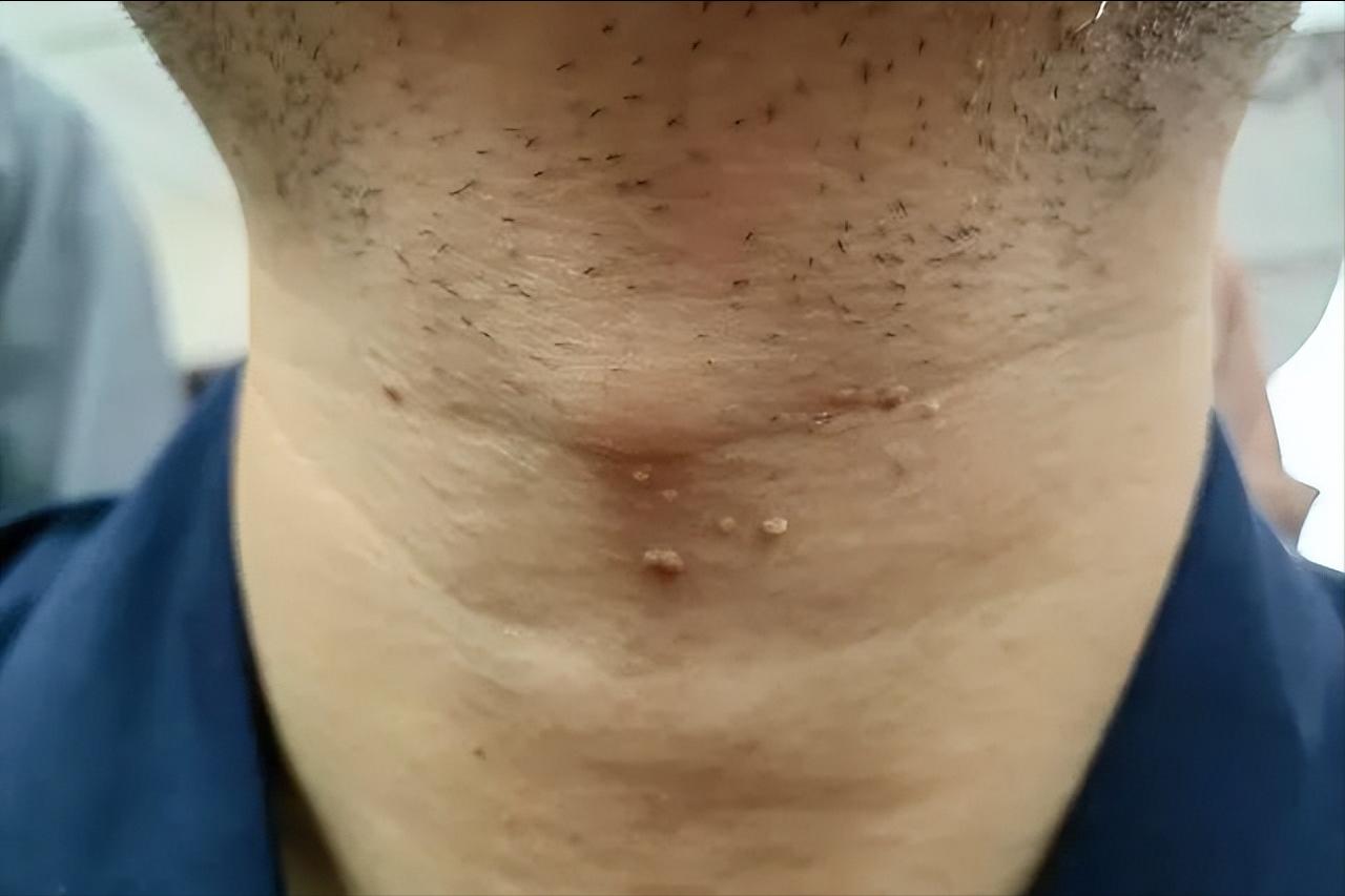 Meat bumps on the head and back, are they the same? - iNEWS