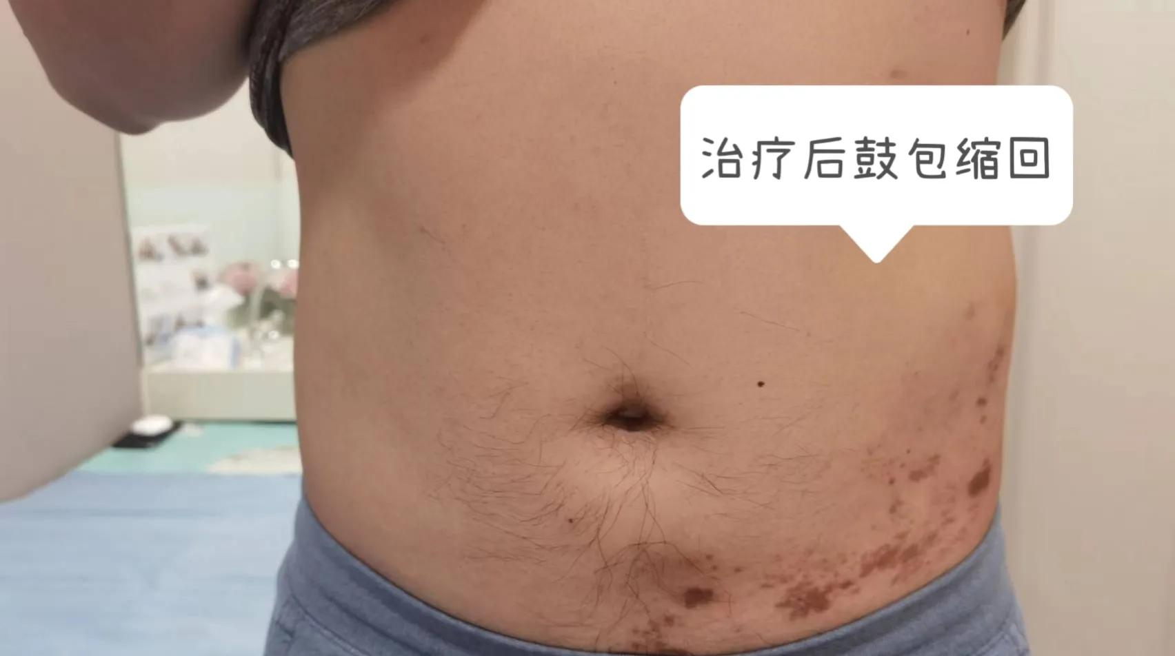 The shingles is cured, why is the belly bulging?——It turned out to be ...