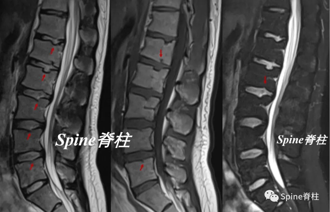 Lumbar Scheuermann's disease - iNEWS