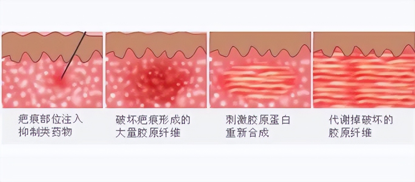 How many times does the scar acupuncture work?Can those scars be ...