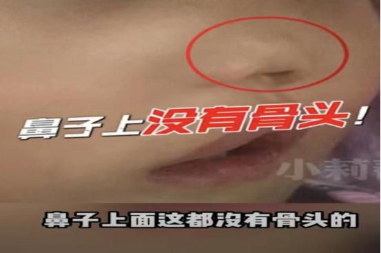 Five-year-old girl without nose bridge or genetic abnormality?Abnormal ...