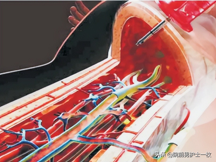 Application of bone marrow cavity puncture technique in first aid - iNEWS