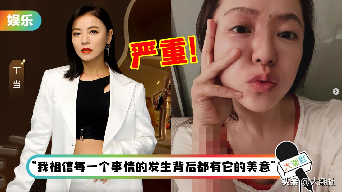 Ding Dang was severely scalded! Face and hand injuries: the speed of ...