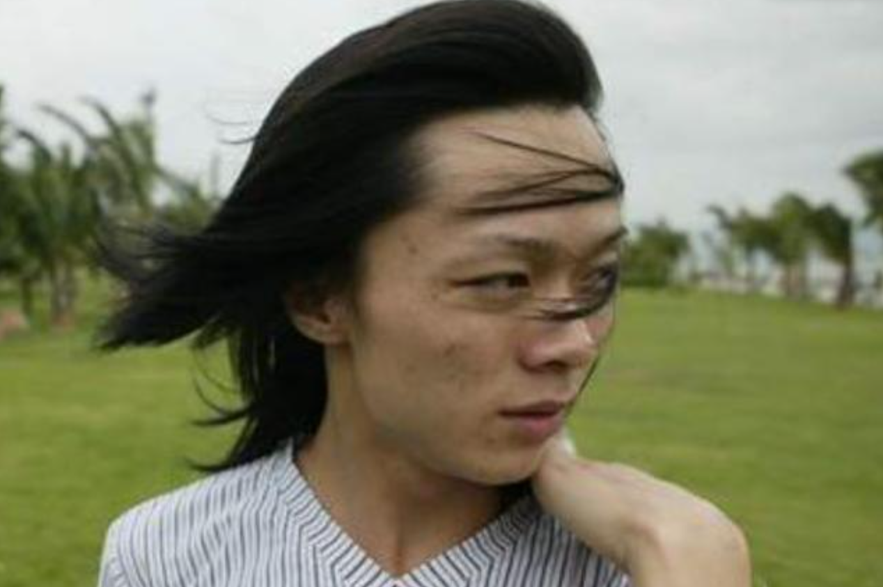 Transgender Li Ermao: She became a "woman" with breast augmentation for ...