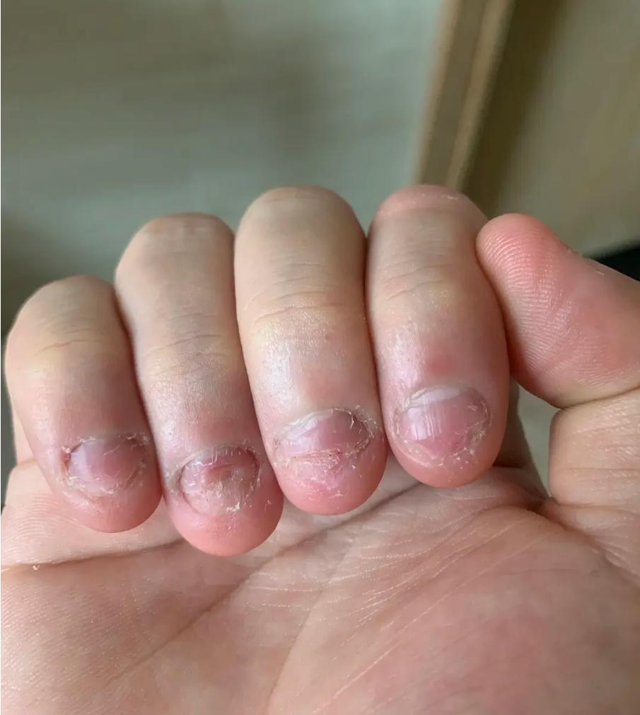 Children who like to bite their fingernails since they were young, can ...