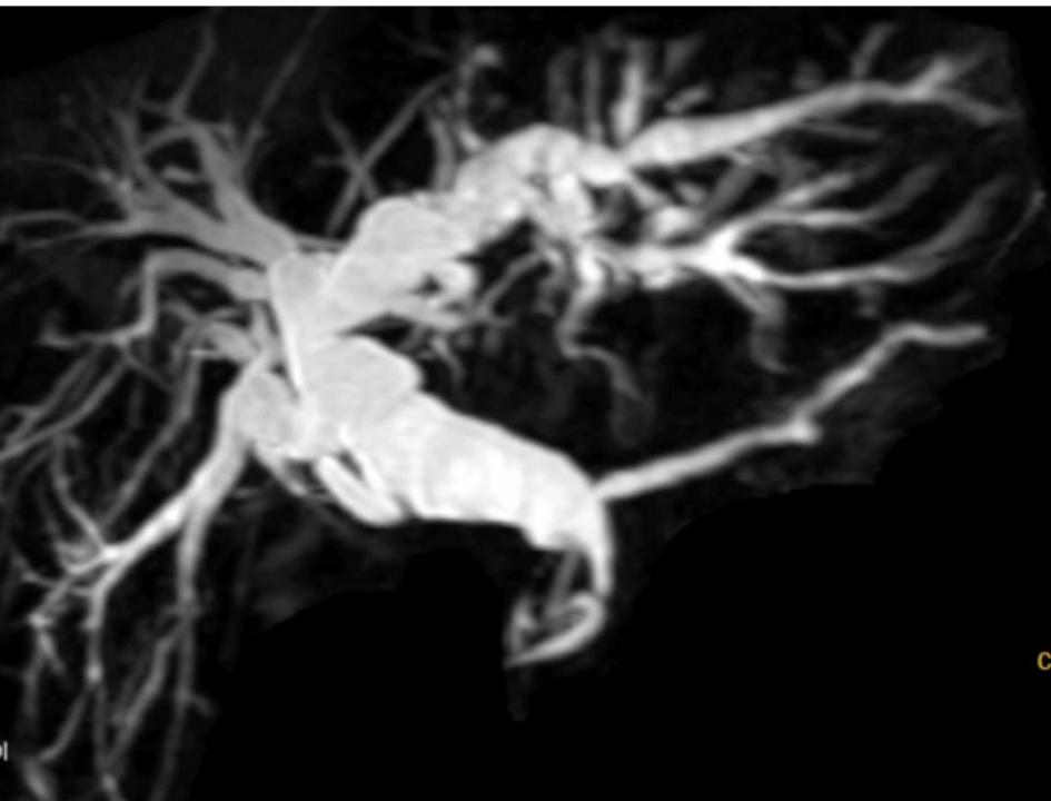 Popular science of MRCP - iNEWS