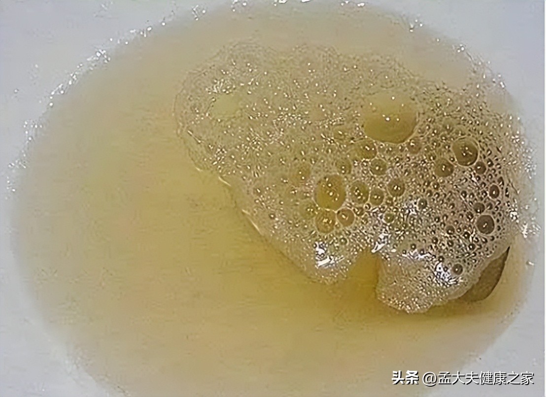 There is a lot of foam in the urine, do you have kidney disease?The ...