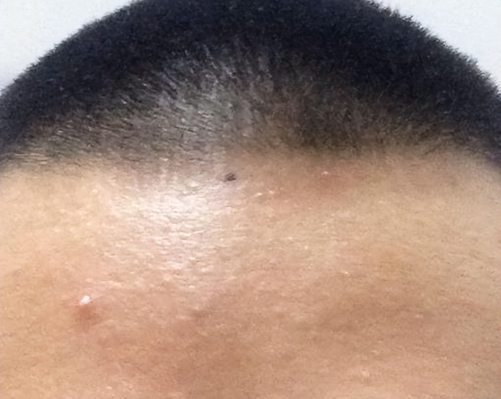 These "moles" on children, or symbols of "good fortune", how many ...