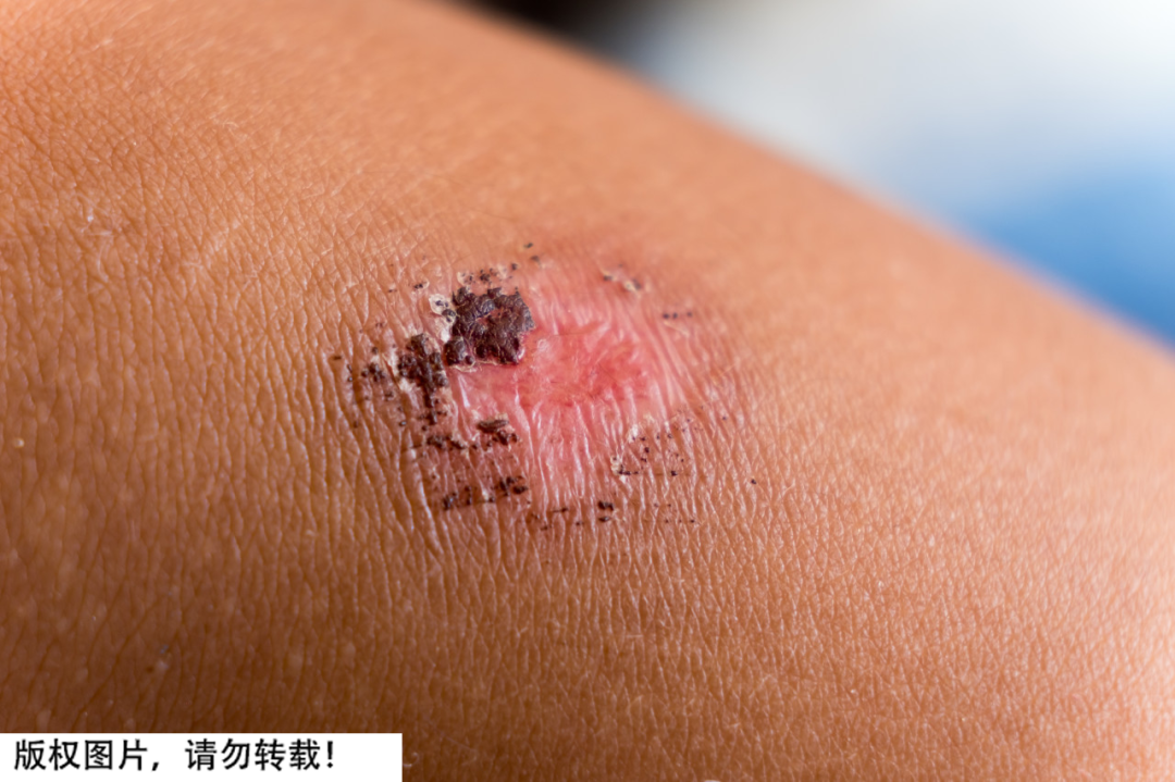 Why is the scab so itchy?The more you pull the top?hurry up... - iNEWS