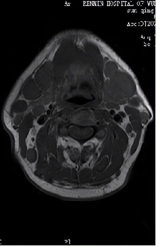 Neck lymphoma and other neck tumors - iNEWS